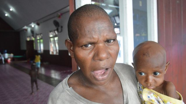 Lima hal yang perlu Anda ketahui tentang wabah campak dan gizi buruk di Asmat - BBC News Indonesia