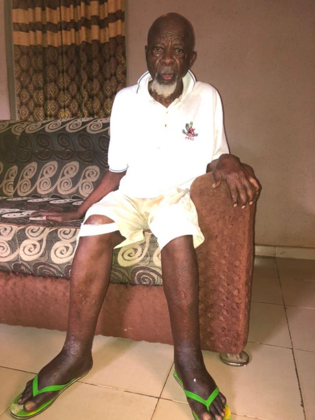 Charles Olumo: Dókítà ní ìfun mi ti já sínú ẹpọ̀n mi - oògùn lásán kò ...