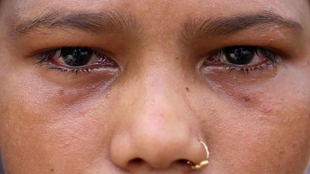 Eye: ఐ ఫ్లూ ఎందుకు వస్తుంది? ఎలా వ్యాపిస్తుంది? - BBC News తెలుగు