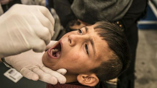 Mumps : गालगुंड किंवा गालफुगी म्हणजे काय? त्याची साथ कशी पसरते? - BBC ...