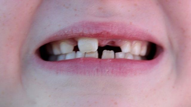 Dental charity blames bad baby teeth on 'child neglect' - BBC News