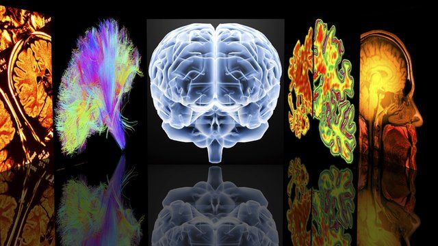 'It's just my brain is misbehaving' - BBC News