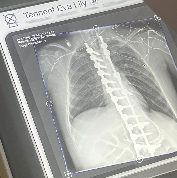 'Inoperable' Eva Tennent gets spinal surgery after review - BBC News