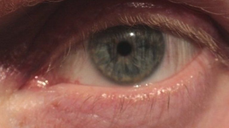 Eye treatment waiting list more than doubles - BBC News