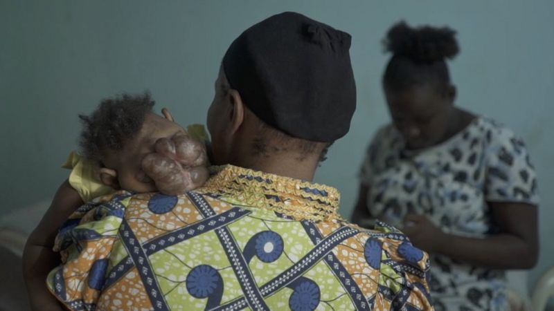 Anencéphalie : quelle est cette maladie qui affecte le crâne des bébés ...