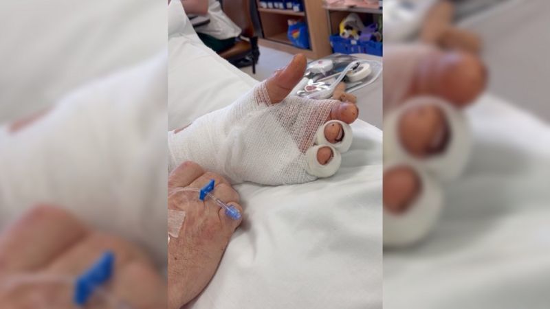 Man has hand reattached after 'horrific' machine accident - BBC News
