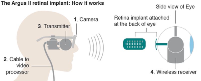 Ten people to get NHS bionic eyes - BBC News