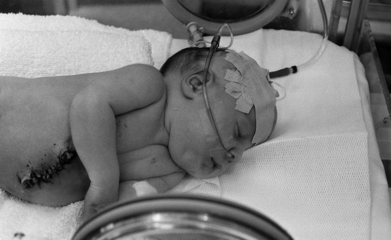 UK's first separated conjoined twins forever grateful to NHS - BBC News