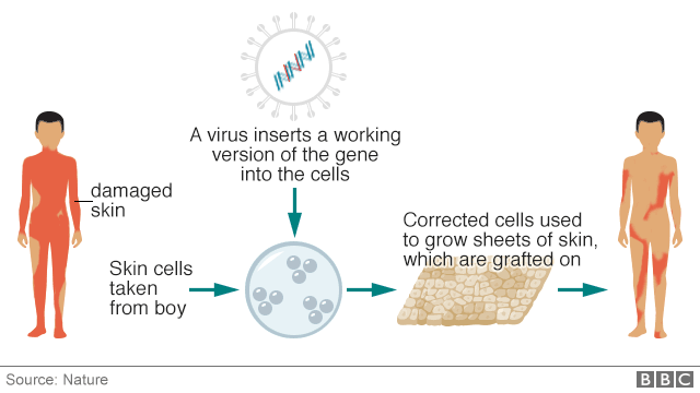 'Butterfly child' given life-saving skin - BBC News