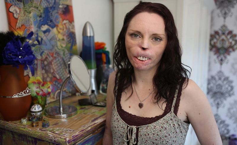 'How I lost my confidence when I lost my face' - BBC News
