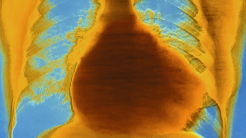 Cardiac 'bruising' may predict worse heart attack - BBC News