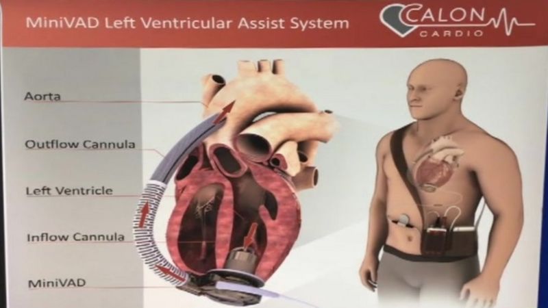 UK's first heart pump targets 2018 clinical trial - BBC News