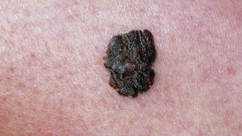 Skin cancer rise warning for over 55s - BBC News