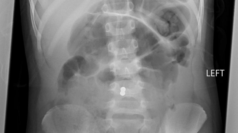 Stevenage mum's warning after two-year-old swallows magnets - BBC News