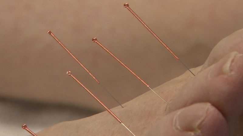 Cancer patient trial finds acupuncture lessens chemotherapy neuropathy ...
