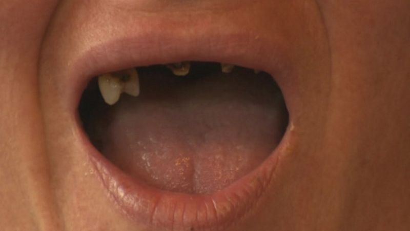 'We couldn't see an NHS dentist so we pulled out our own teeth' - BBC News