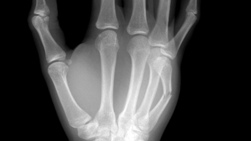 Dead arms test importance of clenched fists - BBC News