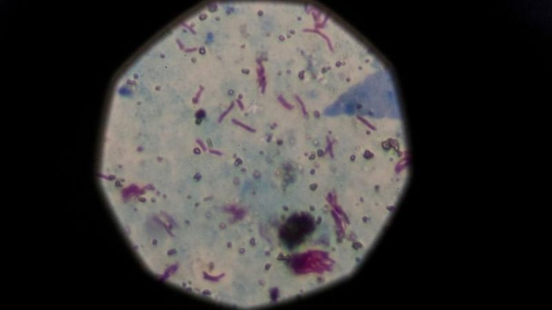 'Game changing' tuberculosis vaccine a step closer - BBC News