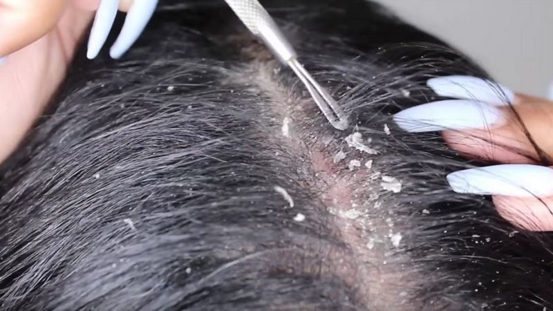 Dandruff, Scalp psoriasis, Ringworm na ihe ndị ọzọ na-eri ntutu gị ...