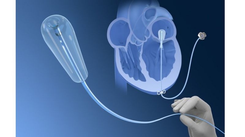 Balloon 'last chance treatment' for heart failure - BBC News