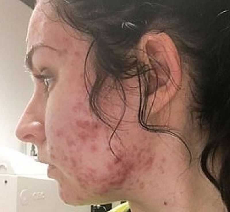 'I woke up one day with severe acne' - BBC News