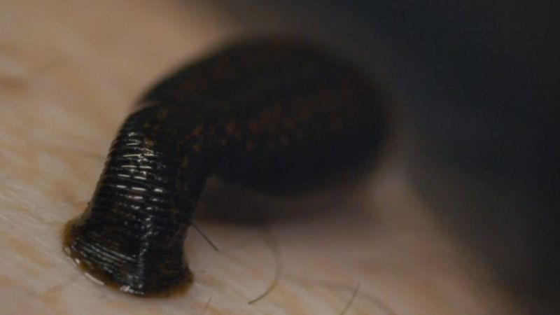 Welsh-farmed leeches 'saved thousands of toes' - BBC News