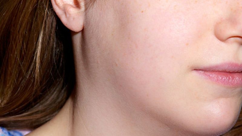 Mumps - is it the forgotten disease? - BBC News