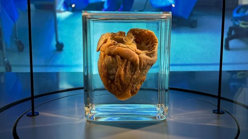 Transplant patient sees own heart go on display at museum - BBC News