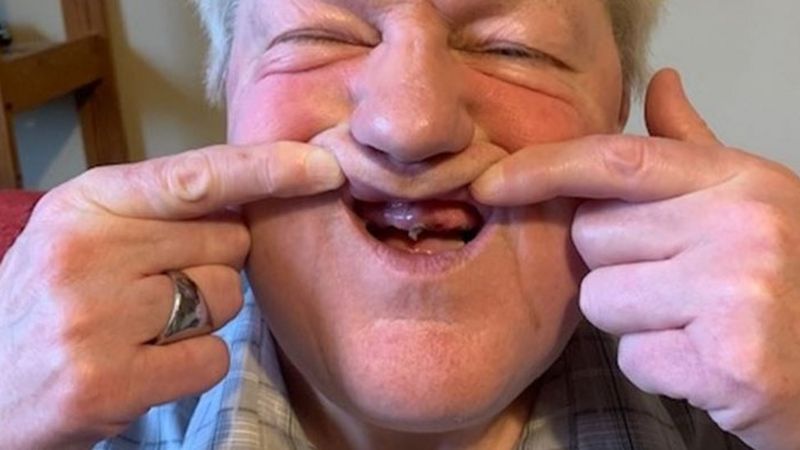NHS dentistry: Ex-miner 'thrilled' to get appointment after seven-month ...