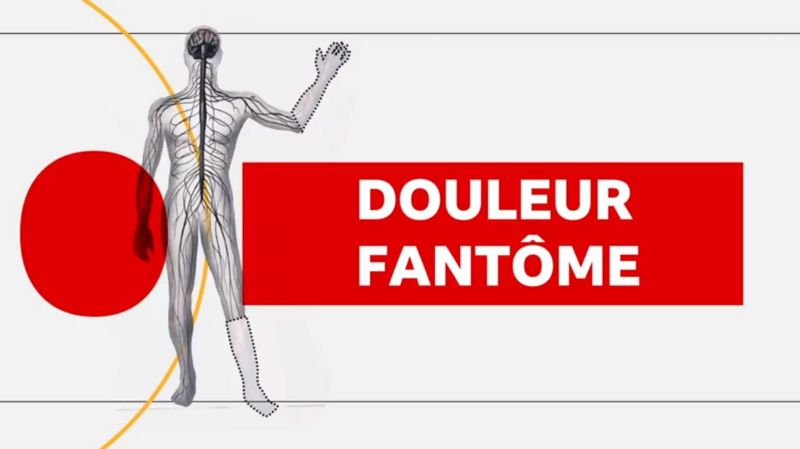 Douleur fantôme : C﻿omment un miroir peut aider à soulager les douleurs ...