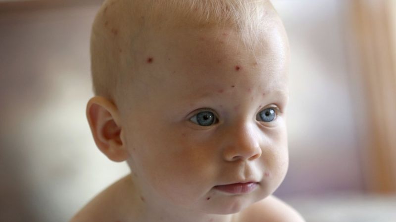 Kentucky teen who sued over vaccine gets chickenpox - BBC News