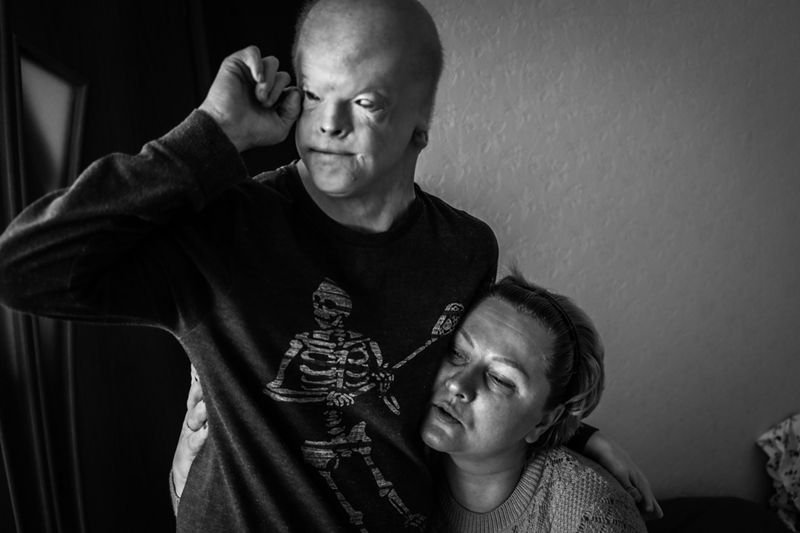 Teenager with rare disability flourishes in new home - BBC News