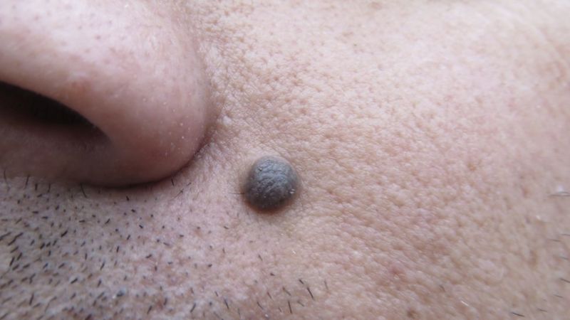 Why do so many people want their moles removed? - BBC News