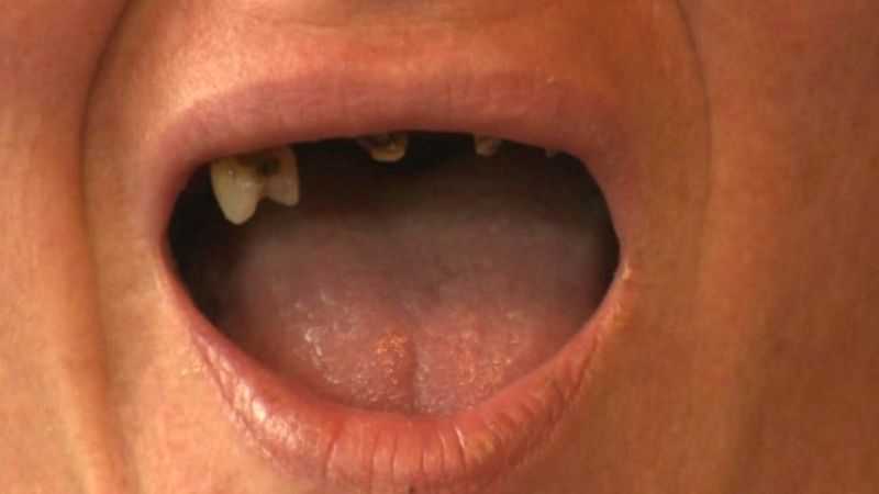 Adult braces: Why are more grown-ups getting their teeth straightened ...