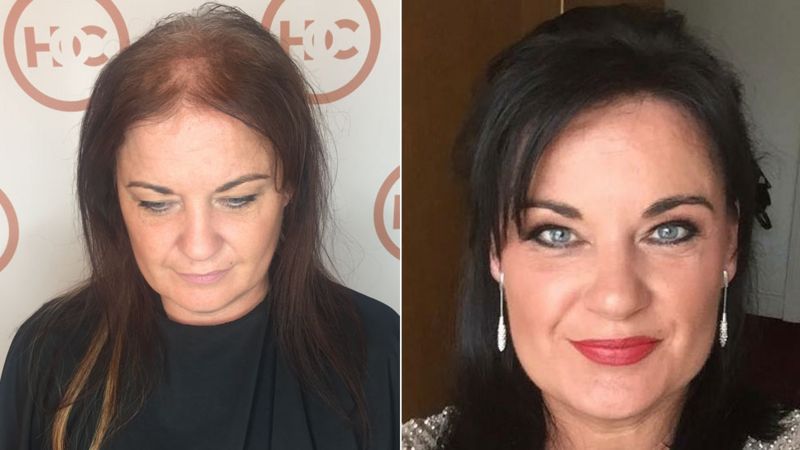 Hair loss: What is female-pattern baldness? - BBC News
