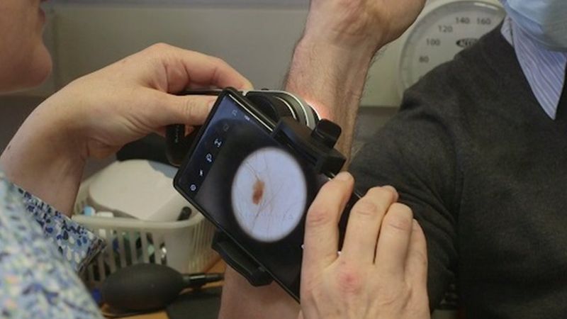 Skin cancer: GPs use app to speed up treatment - BBC News