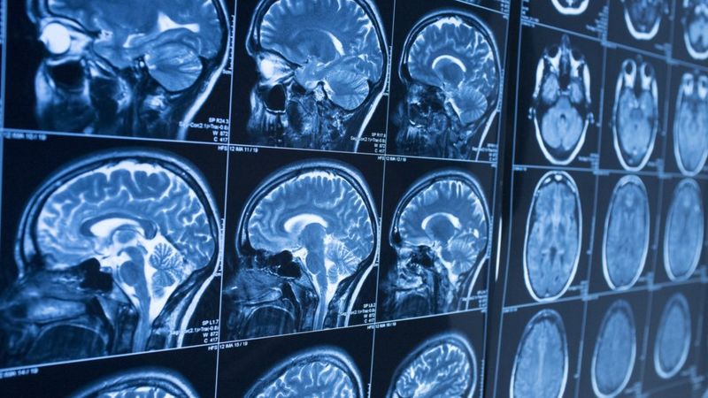 MRI scan delays causing East Midlands patients 'distress' - BBC News