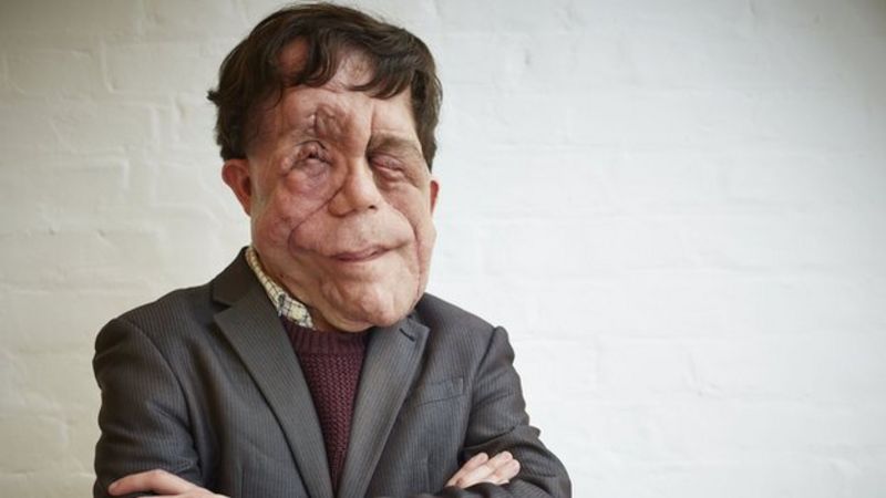 The children living with facial disfigurements - BBC News
