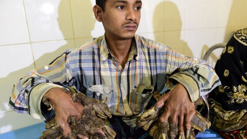 Bangladeshi Girl May Be First Female With Tree Man Syndrome Bbc News