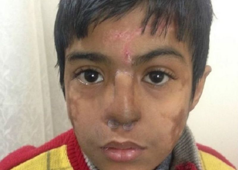 Indian doctors grow new nose on boy's forehead - BBC News
