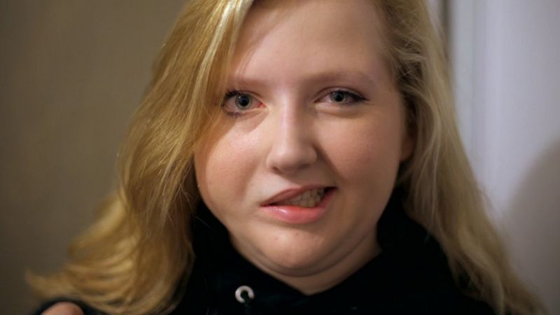 The children living with facial disfigurements - BBC News