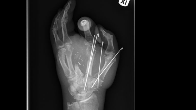 Surgeons save hand severed by electric saw - BBC News