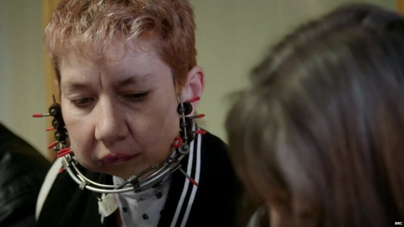 Woman's missing jaw regrown by 9cm after cancer - BBC News