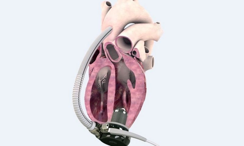 What's it like to live with a mechanical heart pump? - BBC News