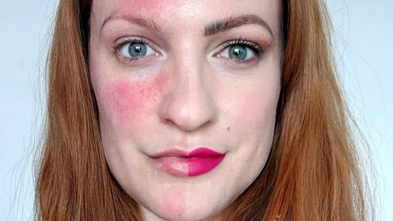 Rosacea: 'Your skin doesn't define you' - BBC News