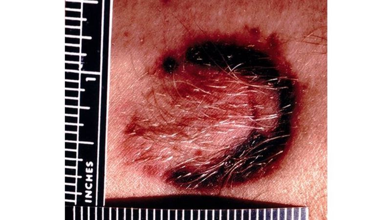 Can you catch a killer using only teeth marks? - BBC News