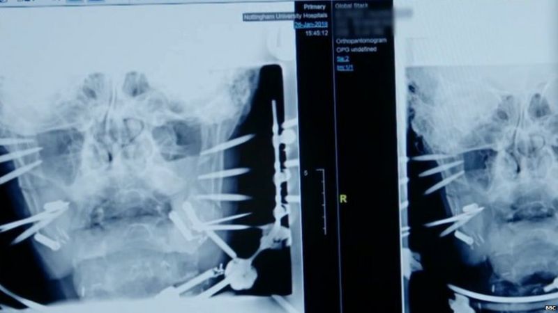 Woman's missing jaw regrown by 9cm after cancer - BBC News