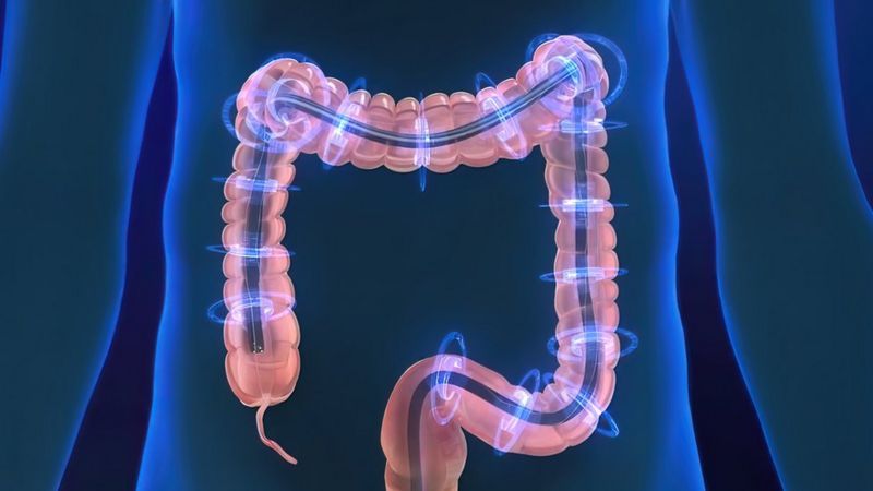 O que é colite microscópica, doença intestinal de difícil diagnóstico ...