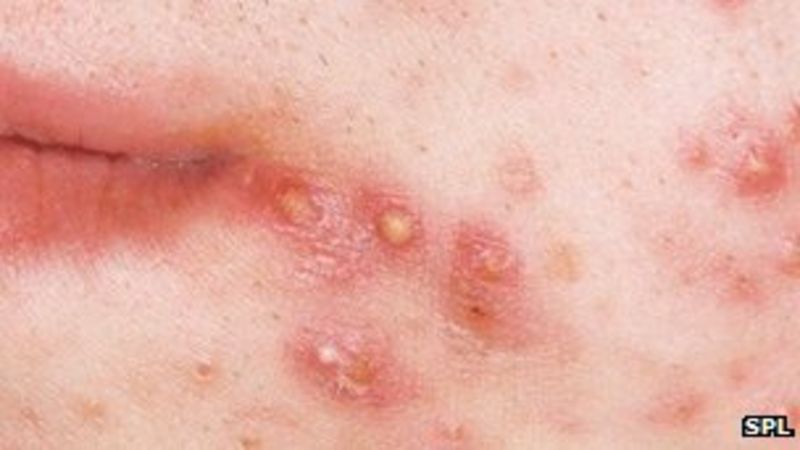 'Harmless skin virus' fights acne - BBC News