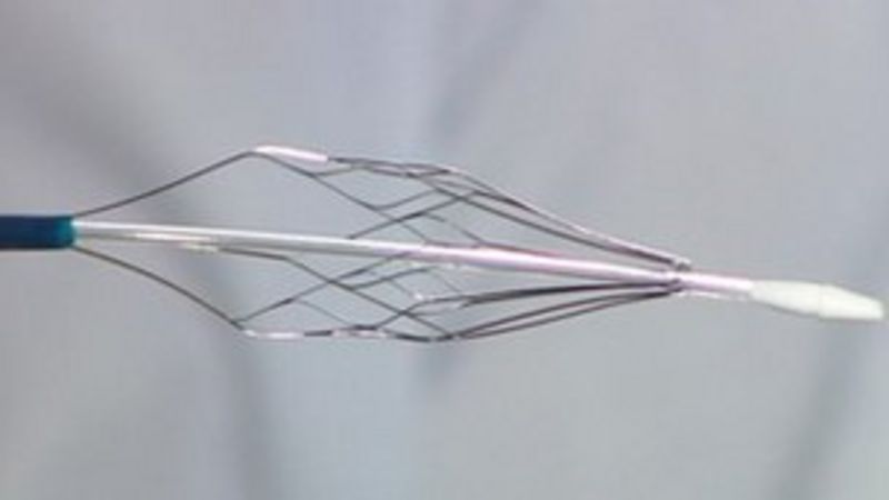 Woman, 80, gets new blood clot prevention device - BBC News
